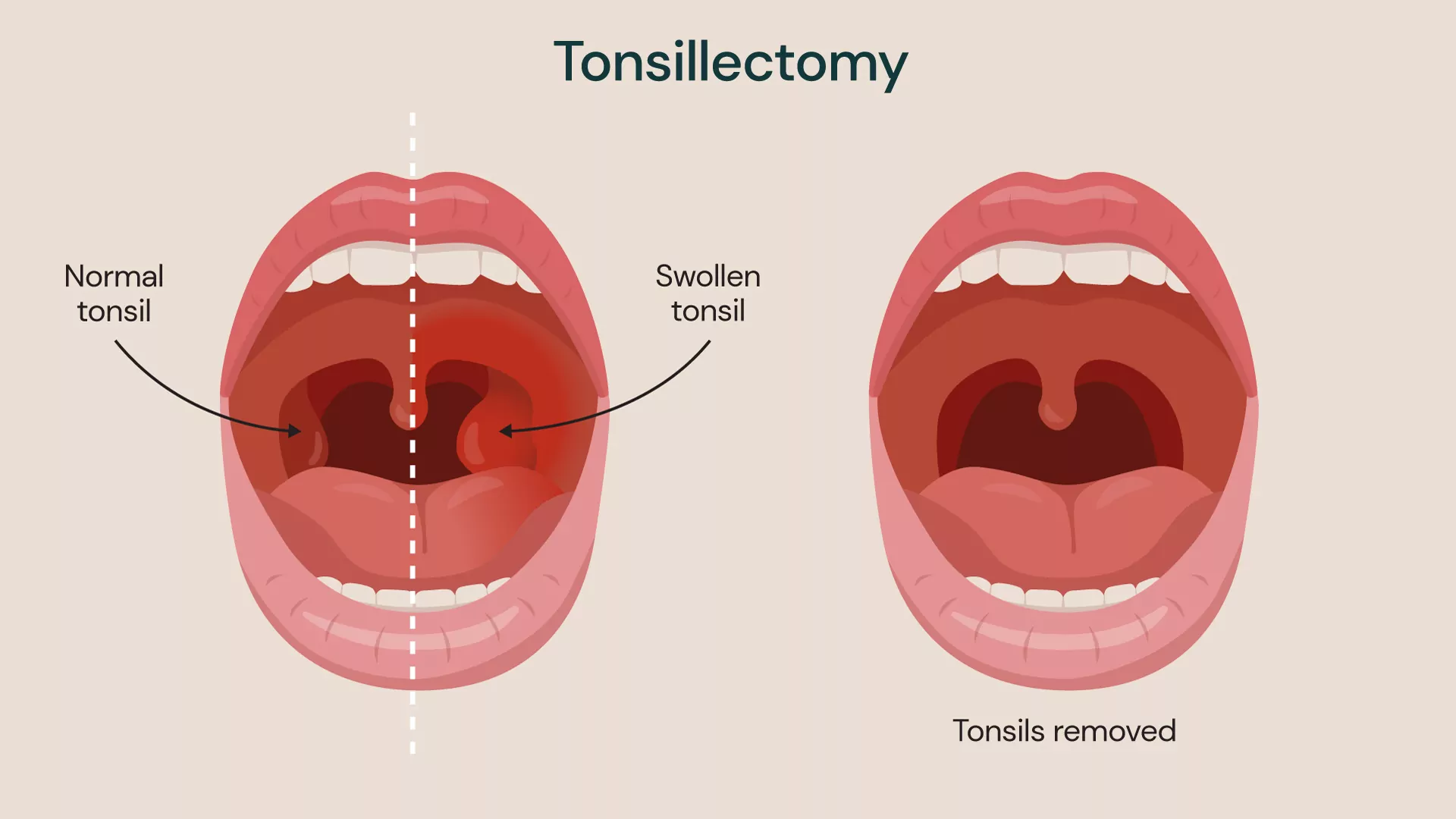 What to Expect During a Tonsillectomy: A Complete Guide - Dr Anil Gwaliorkar